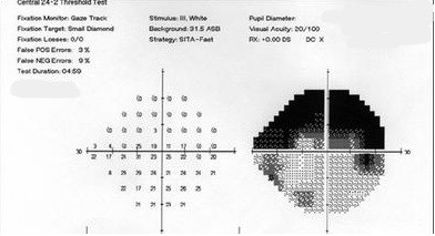 Synsnerven / synsfelt Arkiv - Grå stær operation