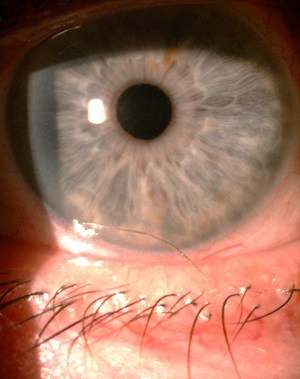 Trikiasis - Grå stær operation